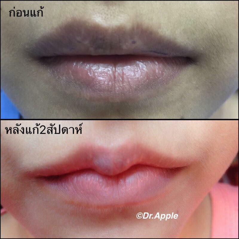 Unusual Beauty Craze Has Thai Women Shaping Their Lips Like Buffalo Horns