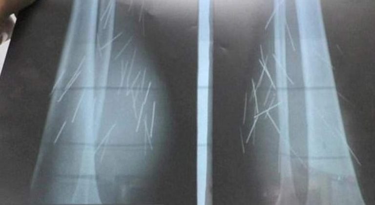 Indian Woman with Over 70 Metal Needles Stuck Deep in Her Legs Claims ...
