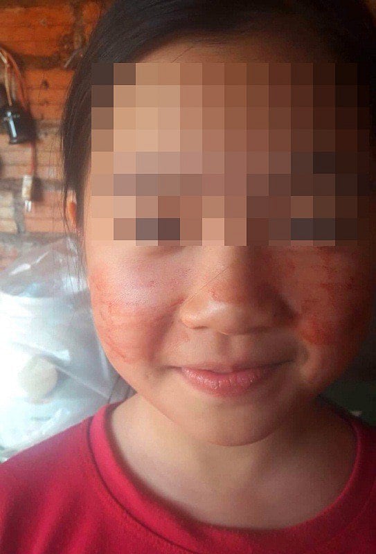 Rare Medical Condition Causes Vietnamese Girl to Sweat Blood Rare Medical Condition Causes Vietnamese Girl to Sweat Blood