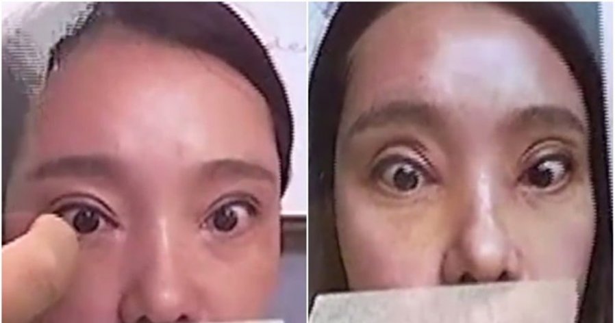 Woman Unable to Fully Close Her Eyes After Botched Double Eyelid Surgery