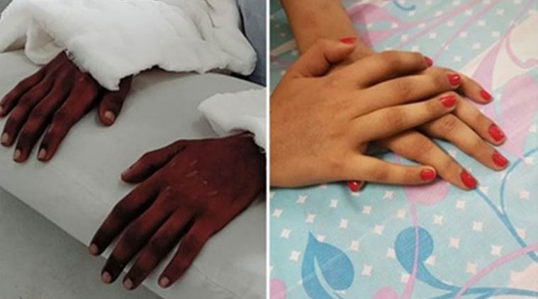 The Curious Case of a Double Amputee Whose Transplanted Hands Have ...