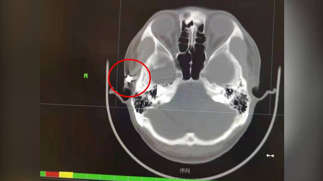 Man Suffering From Severe Headaches Lived With Bullet in His Skull for ...