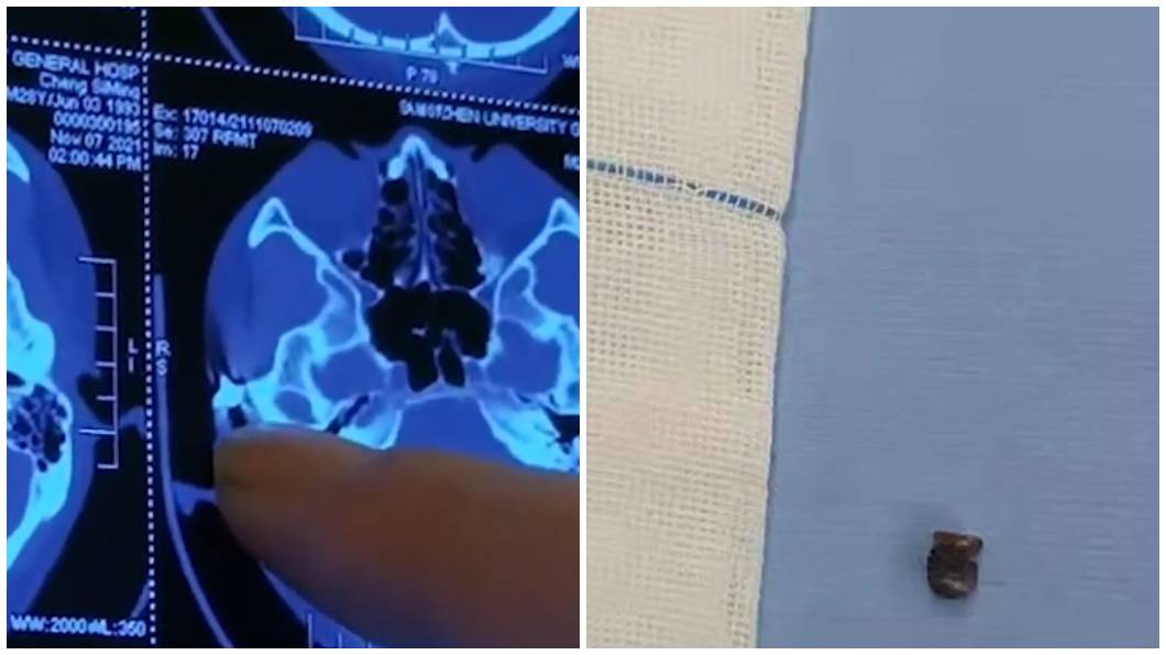 Man Suffering From Severe Headaches Lived With Bullet in His Skull for ...