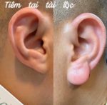 People Are Getting Ear Lobe Fillers to Achieve “Lucky Buddha Ears ...