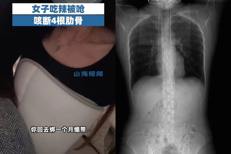 Skinny Woman Breaks Four Ribs While Coughing