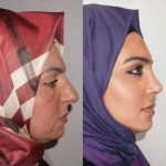 Turkish Plastic Surgery Clinic Goes Viral for “Impossible” Before-And ...