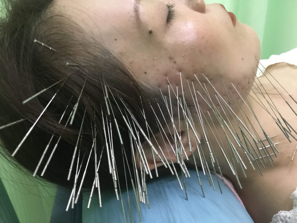 Trendy Acupuncture Technique Turns You into a Human Porcupine