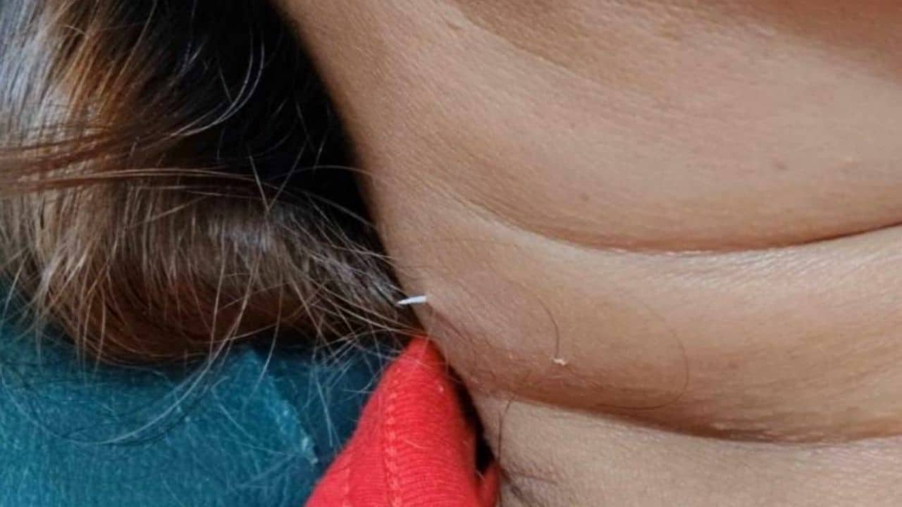 Fish Bone Stuck in Woman’s Throat Eventually Portrudes Through Her Neck