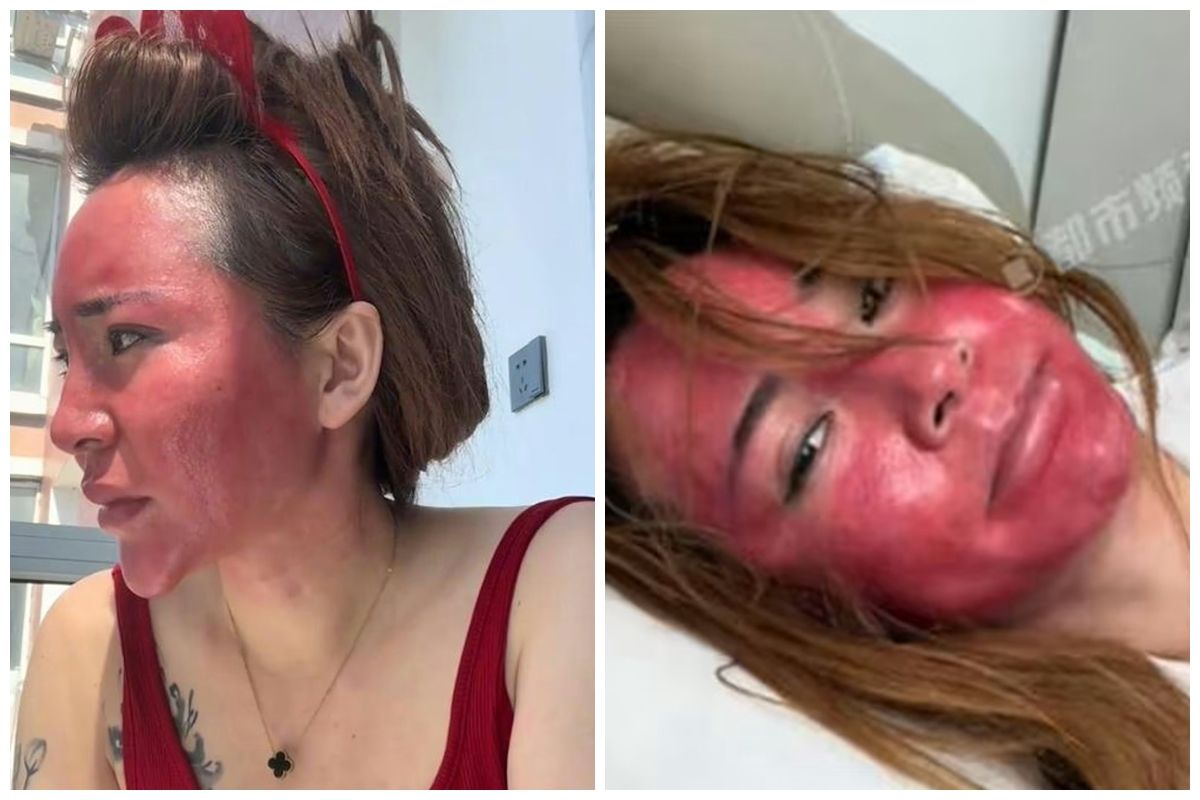 Woman with Severe Face Rash Claims She Hasn’t Removed Makeup in 22 Years