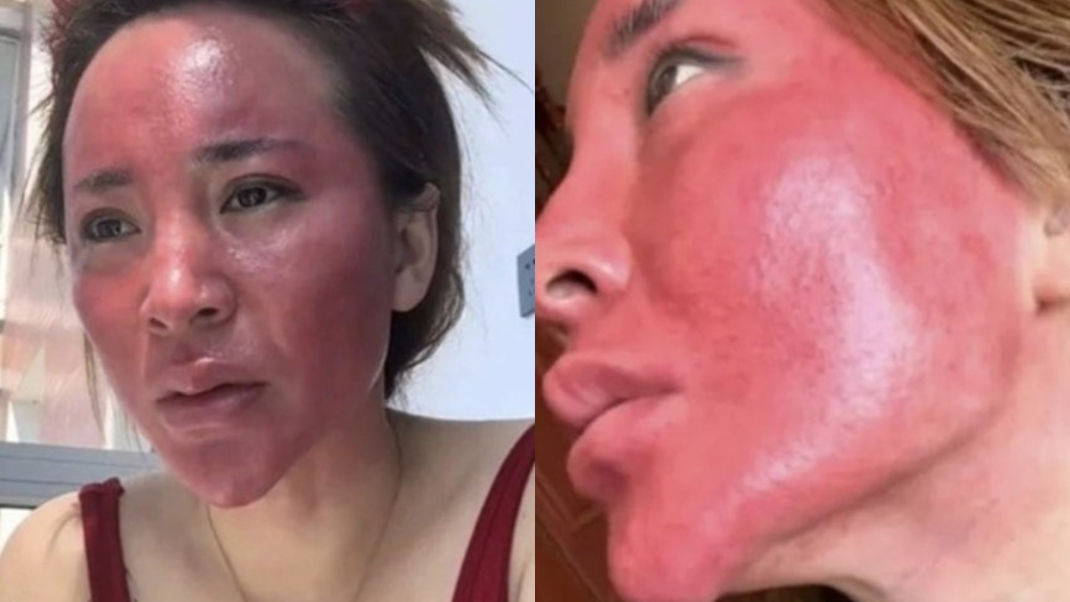 Woman with Severe Face Rash Claims She Hasn’t Removed Makeup in 22 Years