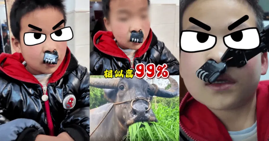 Mischievous Child Gets Combination Lockpad Stuck in His Nose