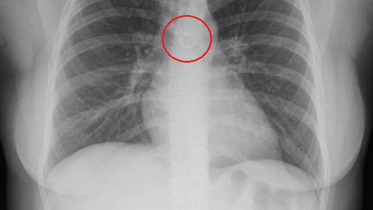 Woman Suffering from Chronic Cough Discovers Nose Piercing Stuck in Her ...